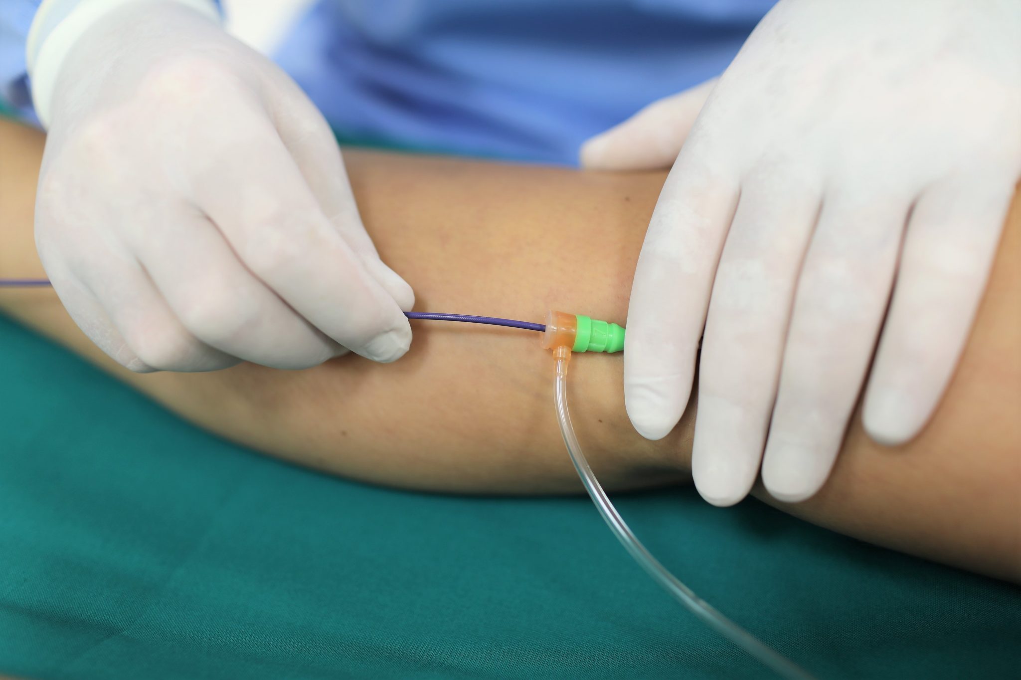 Laserska operacija vena u Specijalnoj bolnici AGRAM